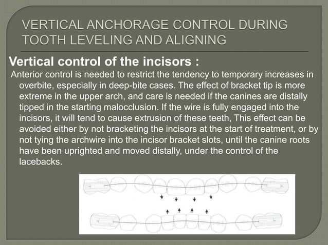 Anchorage control during tooth leveling and aligning | PPTX | Dental ...