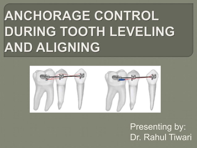 Anchorage control during tooth leveling and aligning | PPT