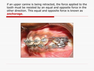 Basics of Orthodontic Anchorage | PPT