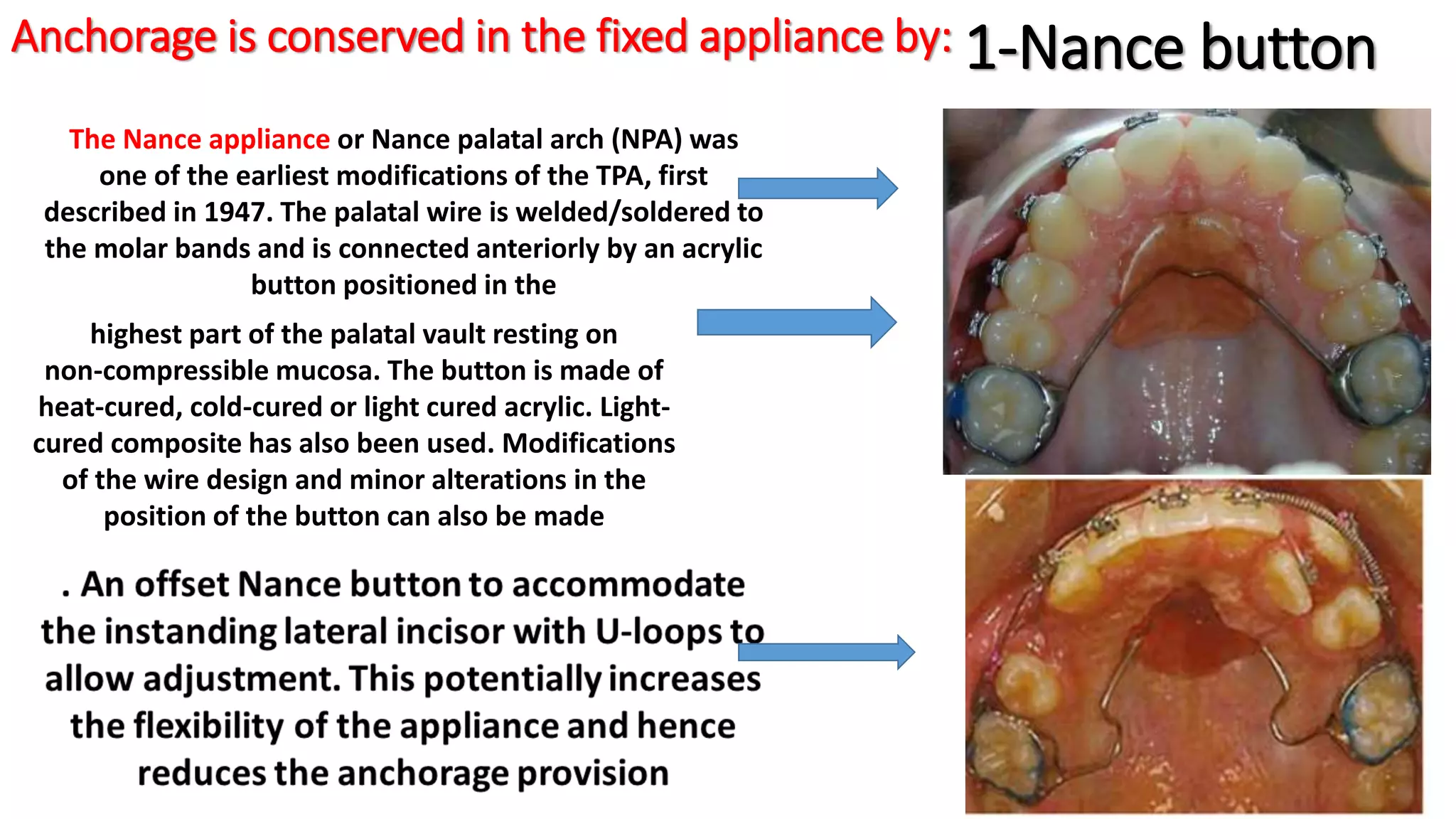 Anchorage for fixed appliance | PPTX