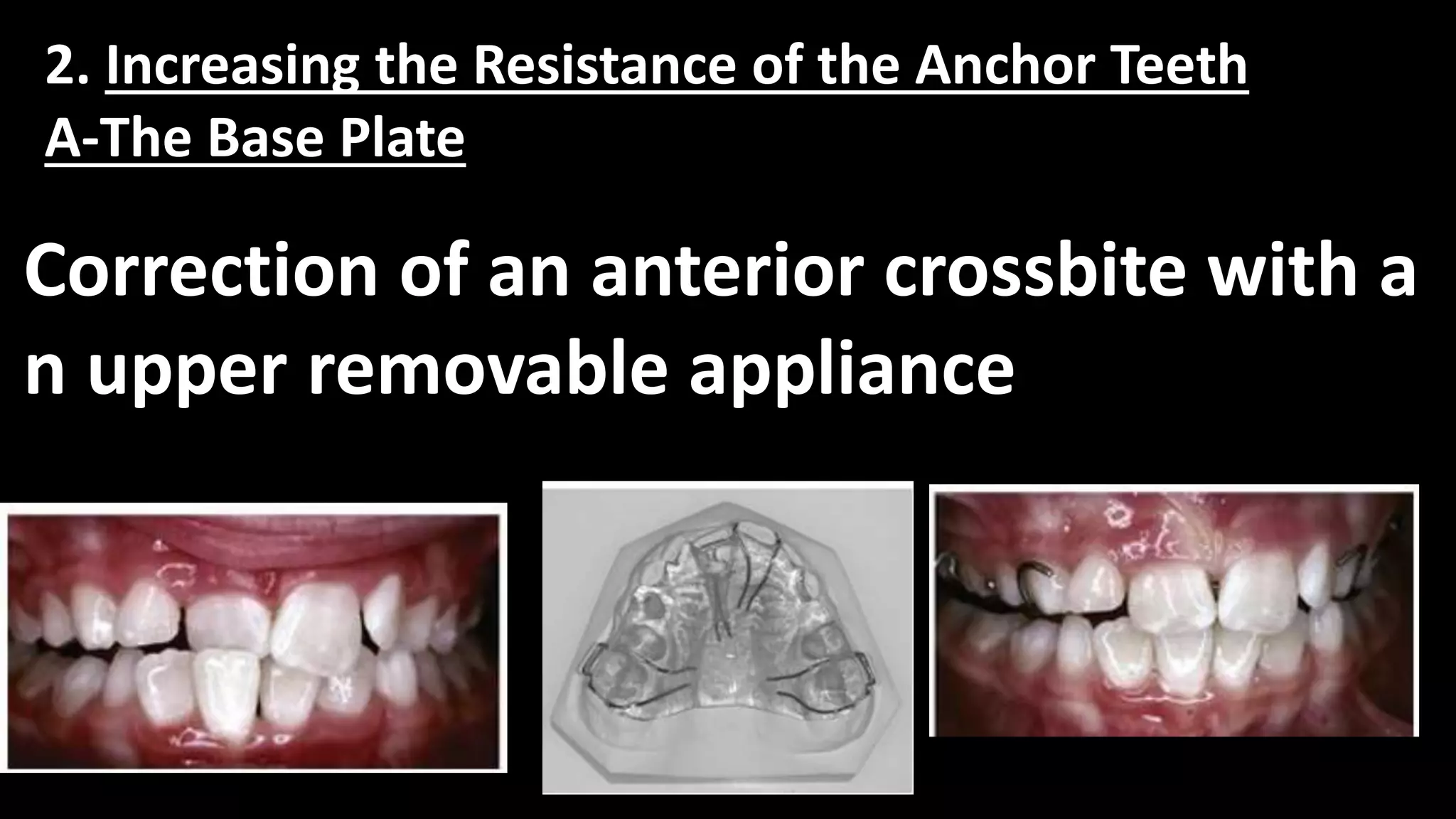 Anchorage for removable orthodontic appliances | PPTX