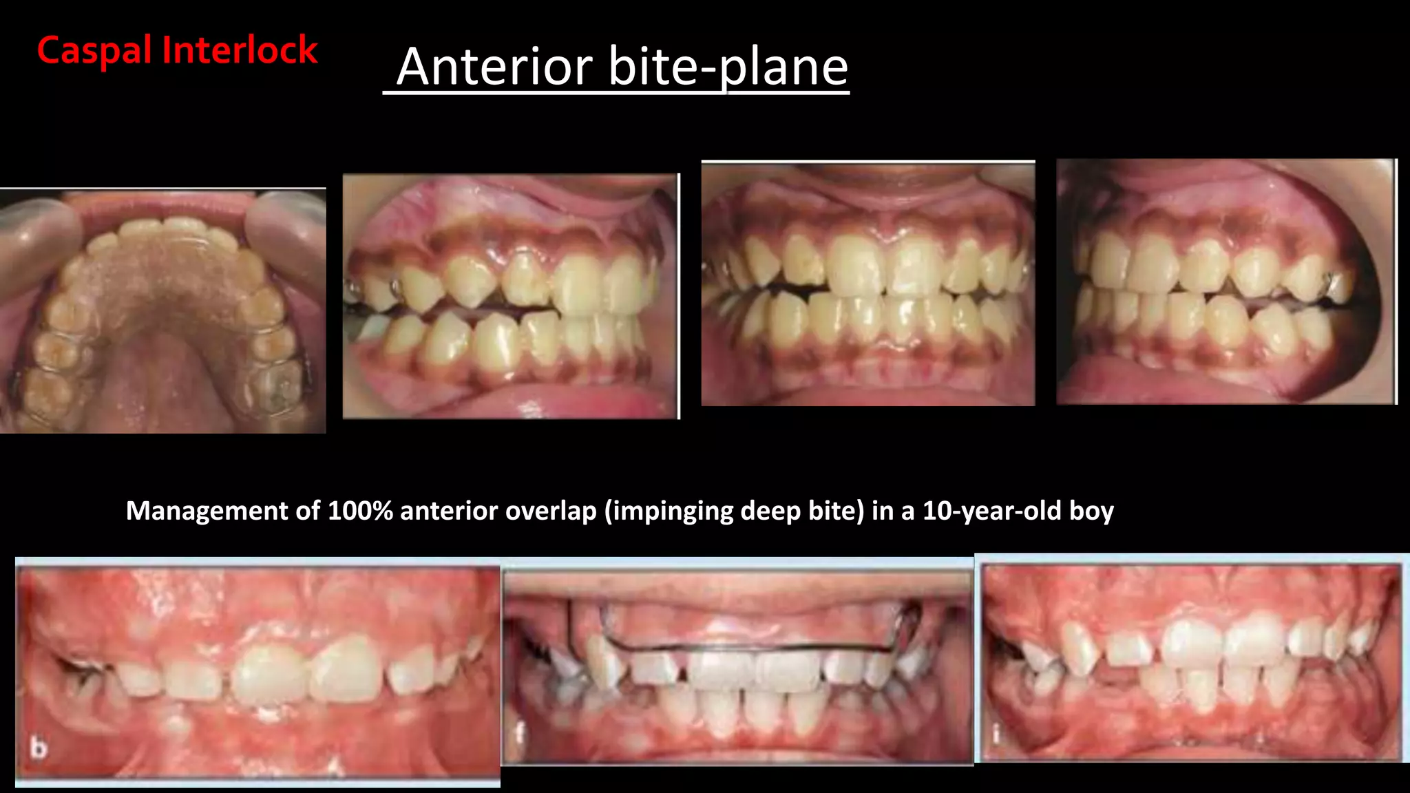 Anchorage for removable orthodontic appliances | PPTX