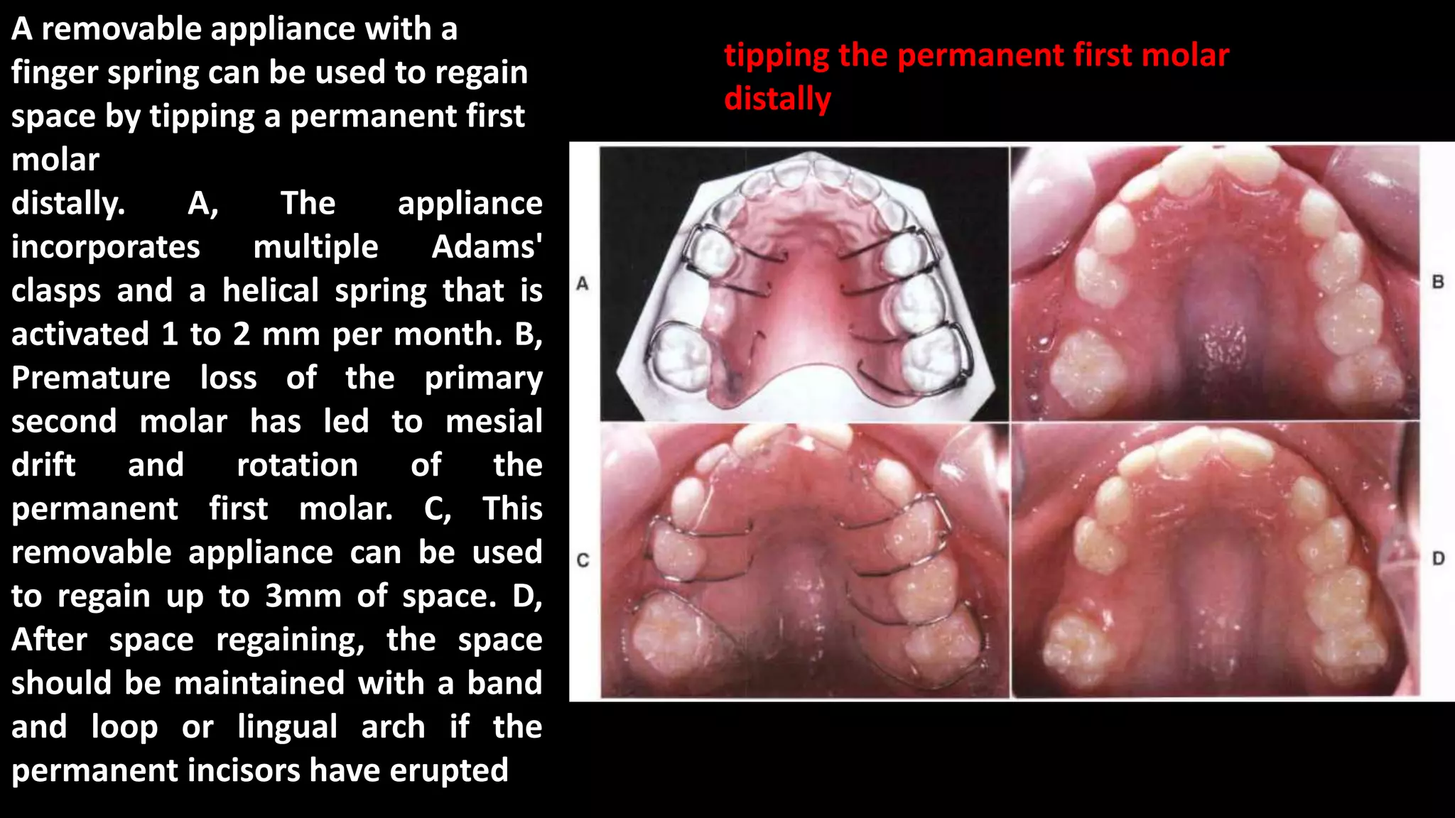 Anchorage for removable orthodontic appliances | PPTX