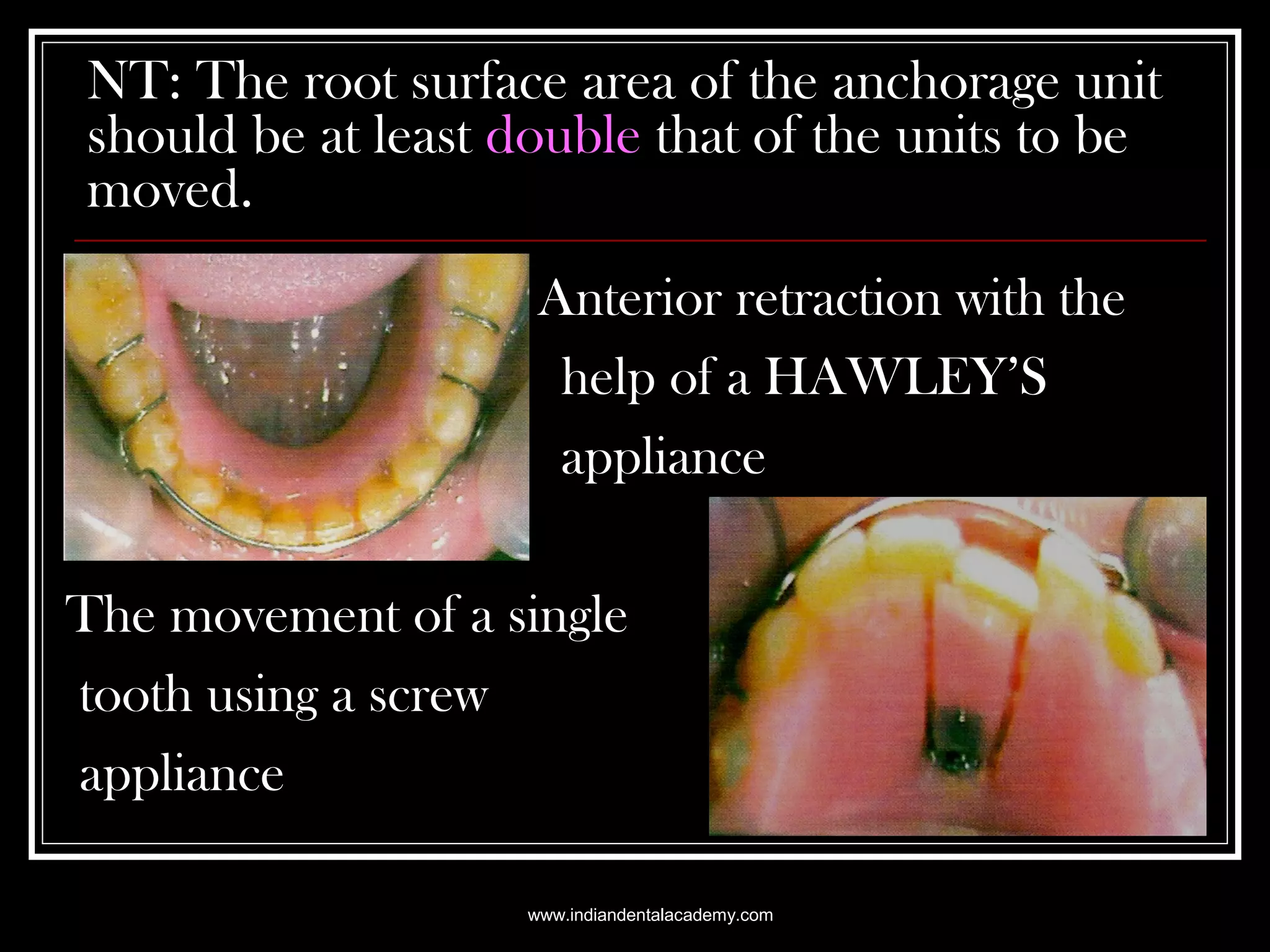 Anchorage in orthodontics /certified fixed orthodontic courses by ...