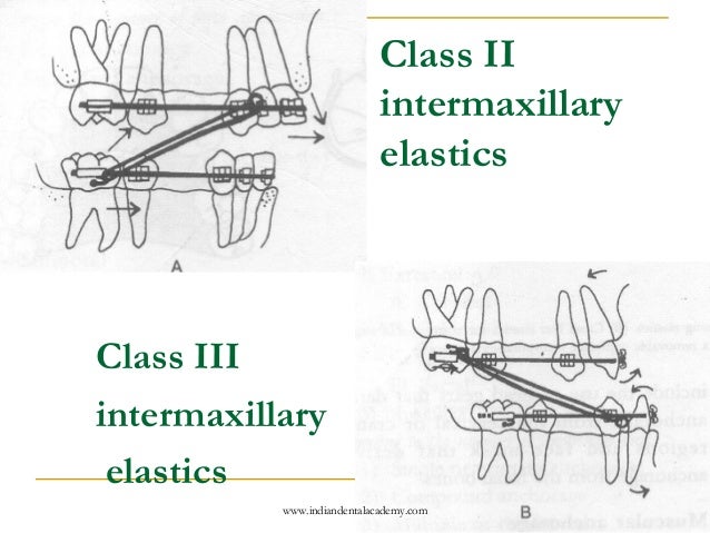Anchorage in orthodontics