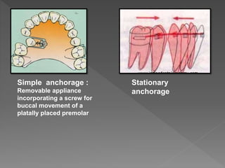 Anchorage in orthodontic treatment | PPTX