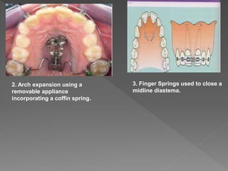 Anchorage in orthodontic treatment | PPTX