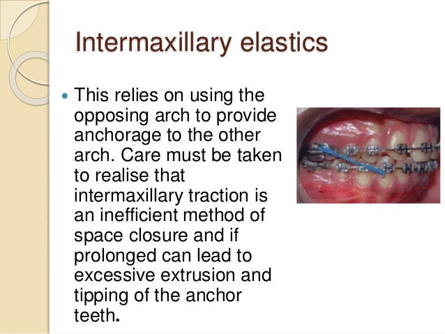 Anchorage in orthodontics- Dr Lubna Abu Alrub