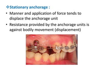 Anchorage in orthodontics | PPT