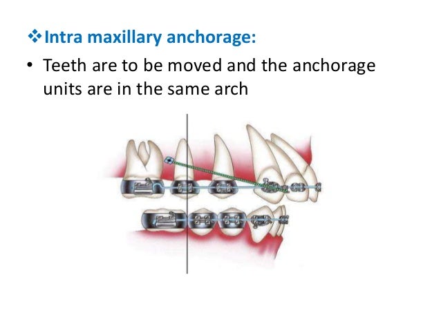 Anchorage in orthodontics
