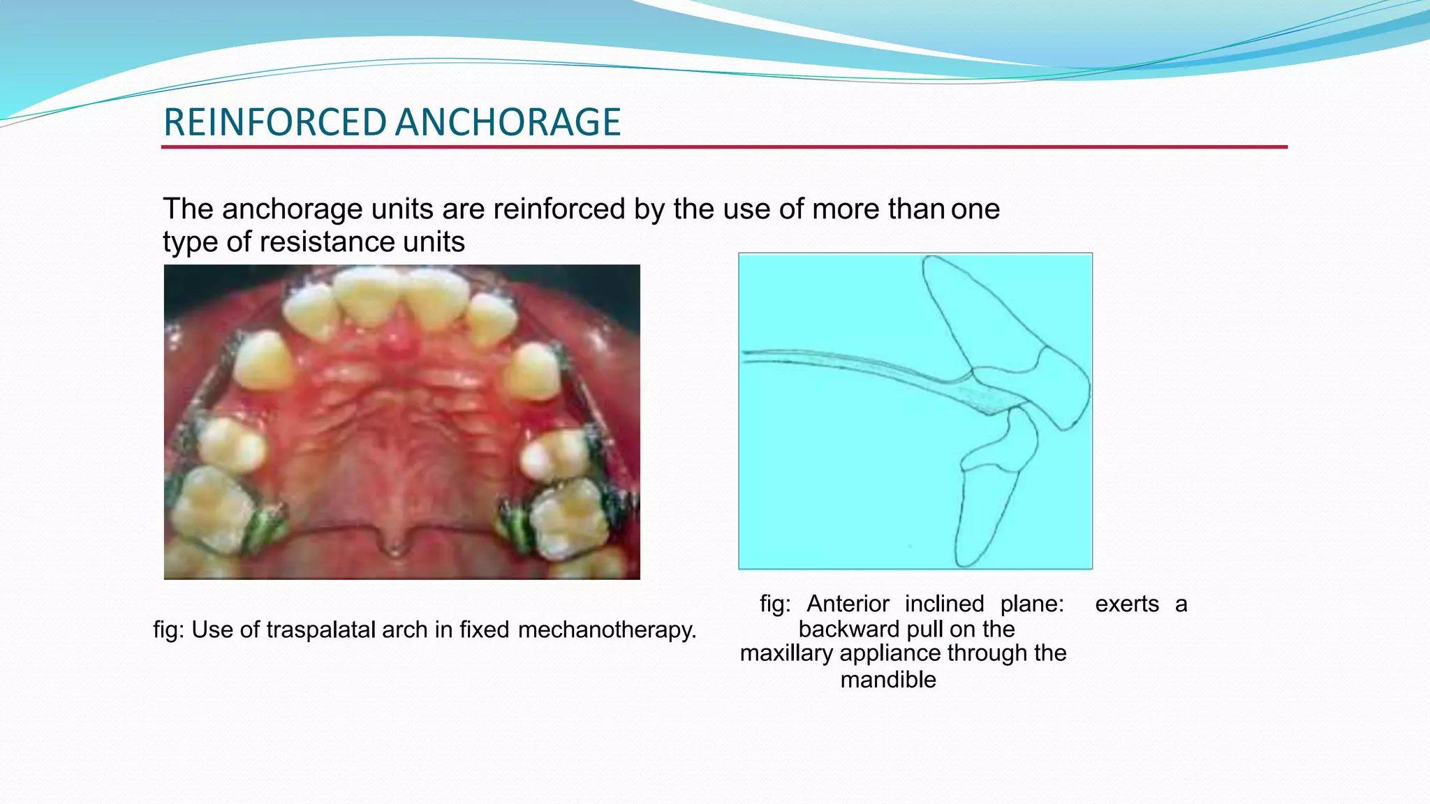 Anchorage in orthodontics | PPTX