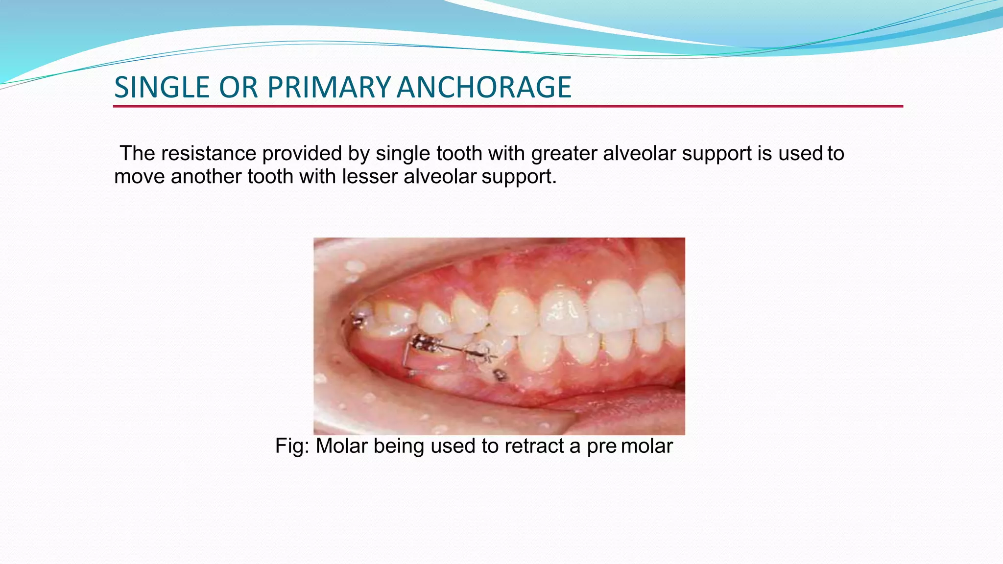Anchorage in orthodontics | PPTX