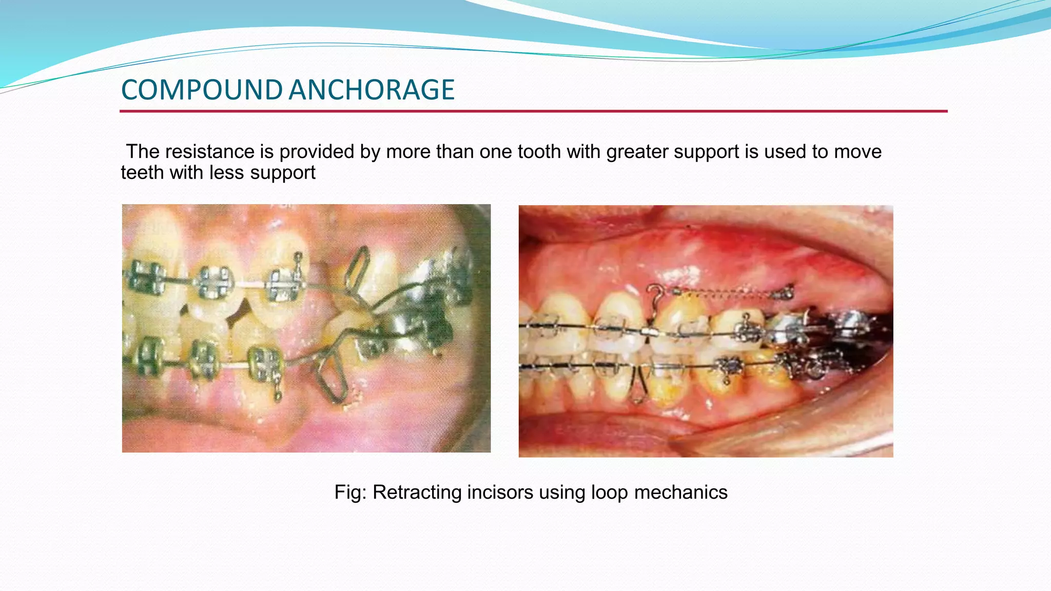 Anchorage in orthodontics | PPTX