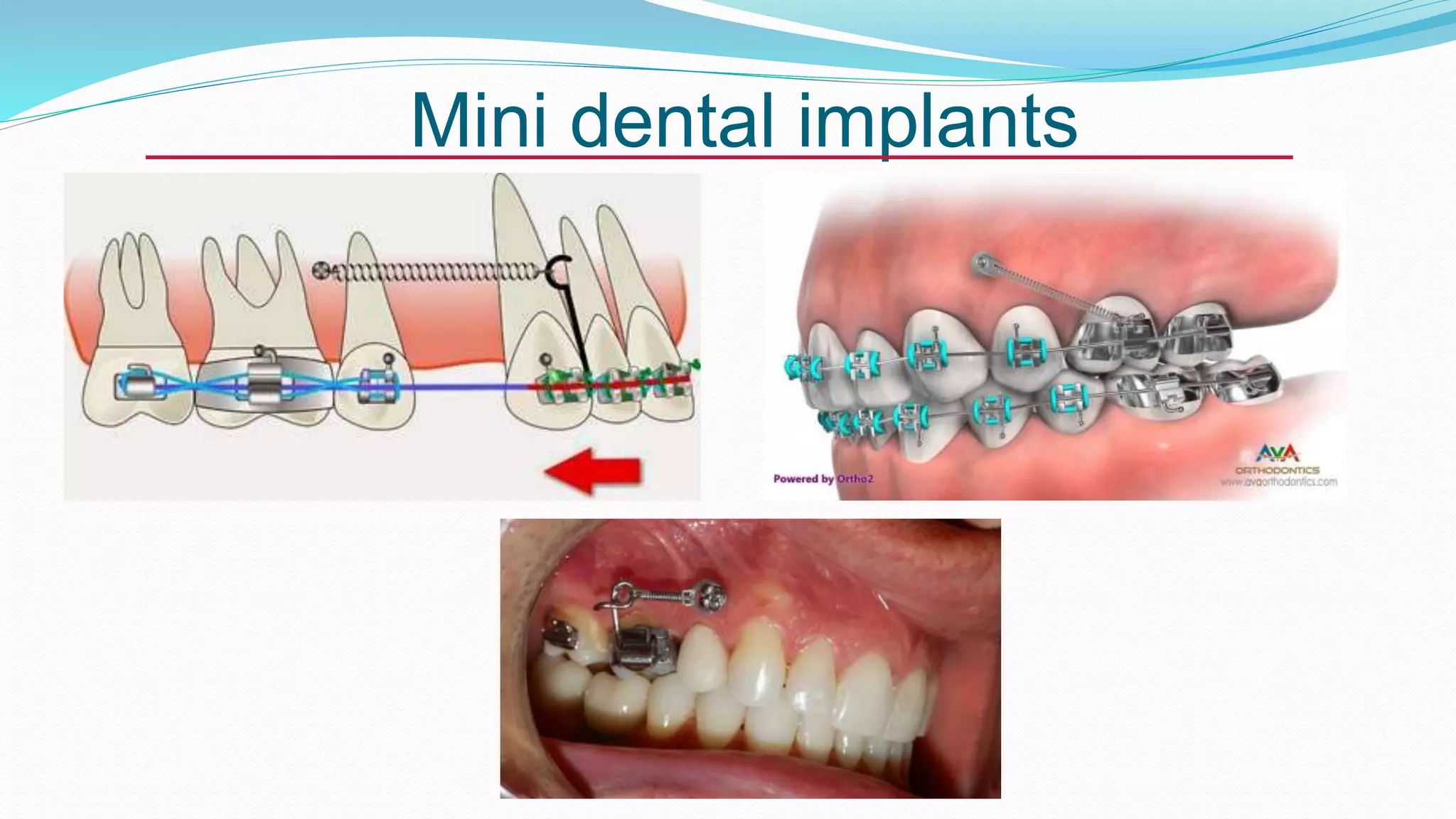 Anchorage in orthodontics | PPTX