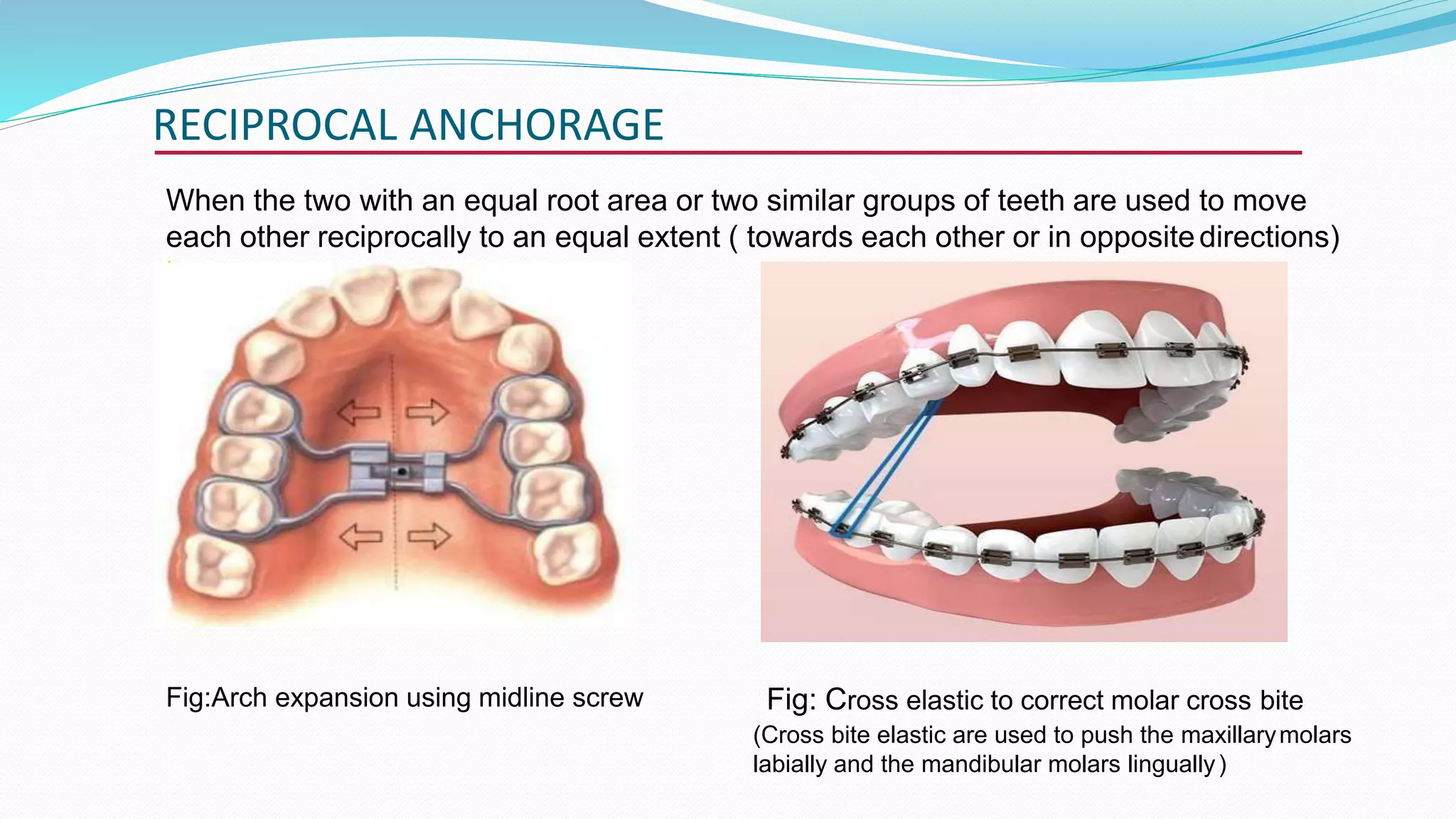 Anchorage in orthodontics | PPTX