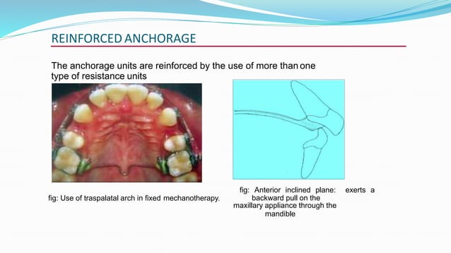 Anchorage in orthodontics | PPTX