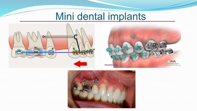 Anchorage in orthodontics | PPTX