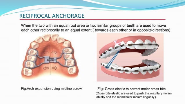 Anchorage in orthodontics | PPTX