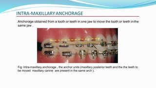 Anchorage in orthodontics | PPTX