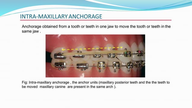 Anchorage in orthodontics | PPTX