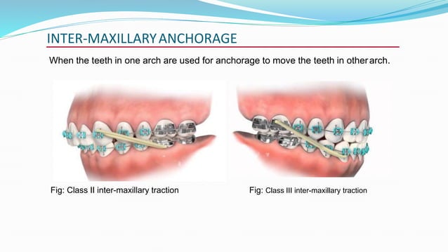 Anchorage in orthodontics | PPTX