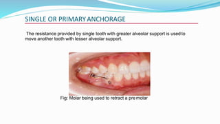 Anchorage in orthodontics | PPT