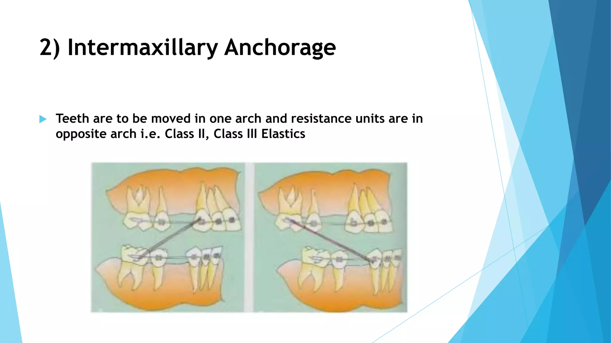 Anchorage in Orthodontics | PPTX