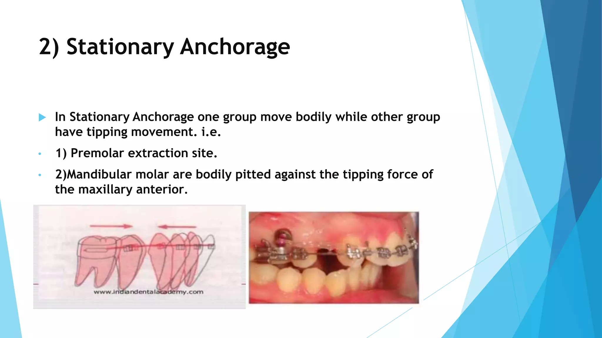 Anchorage in Orthodontics | PPTX