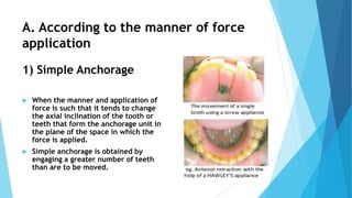 Anchorage in Orthodontics | PPTX