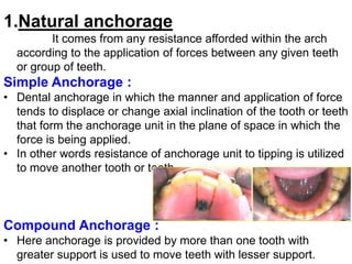 Anchorage in orthodontics | PPT