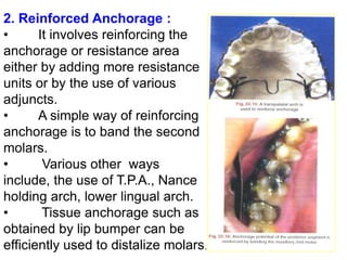 Anchorage in orthodontics | PPT