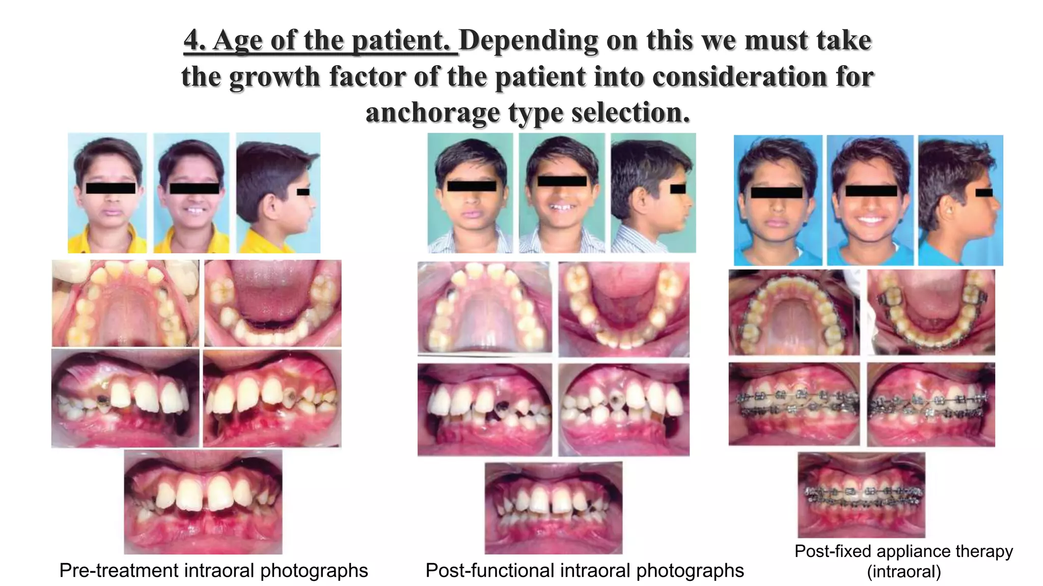 Anchorage in orthodontics | PPTX