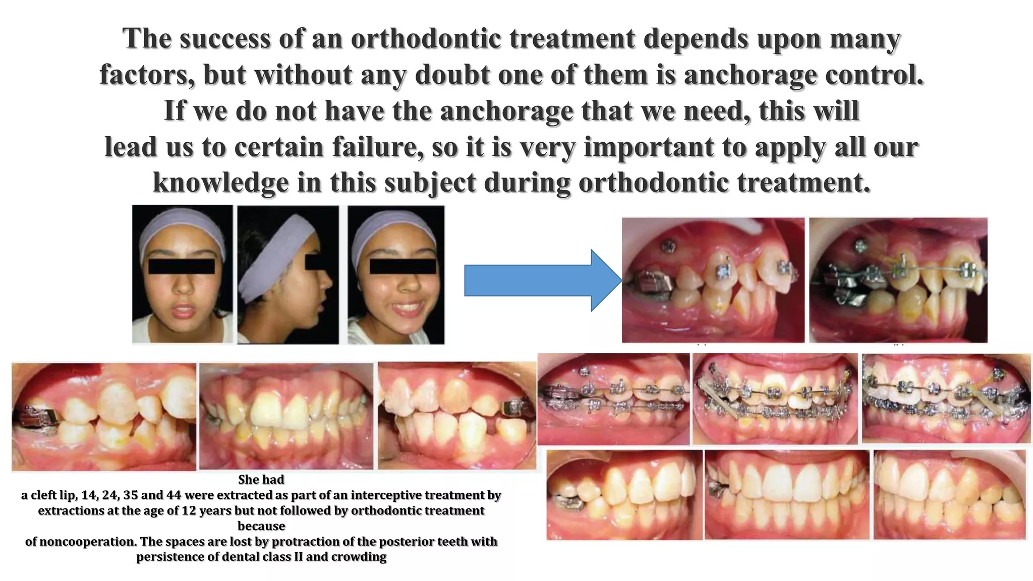 Anchorage in orthodontics | PPTX