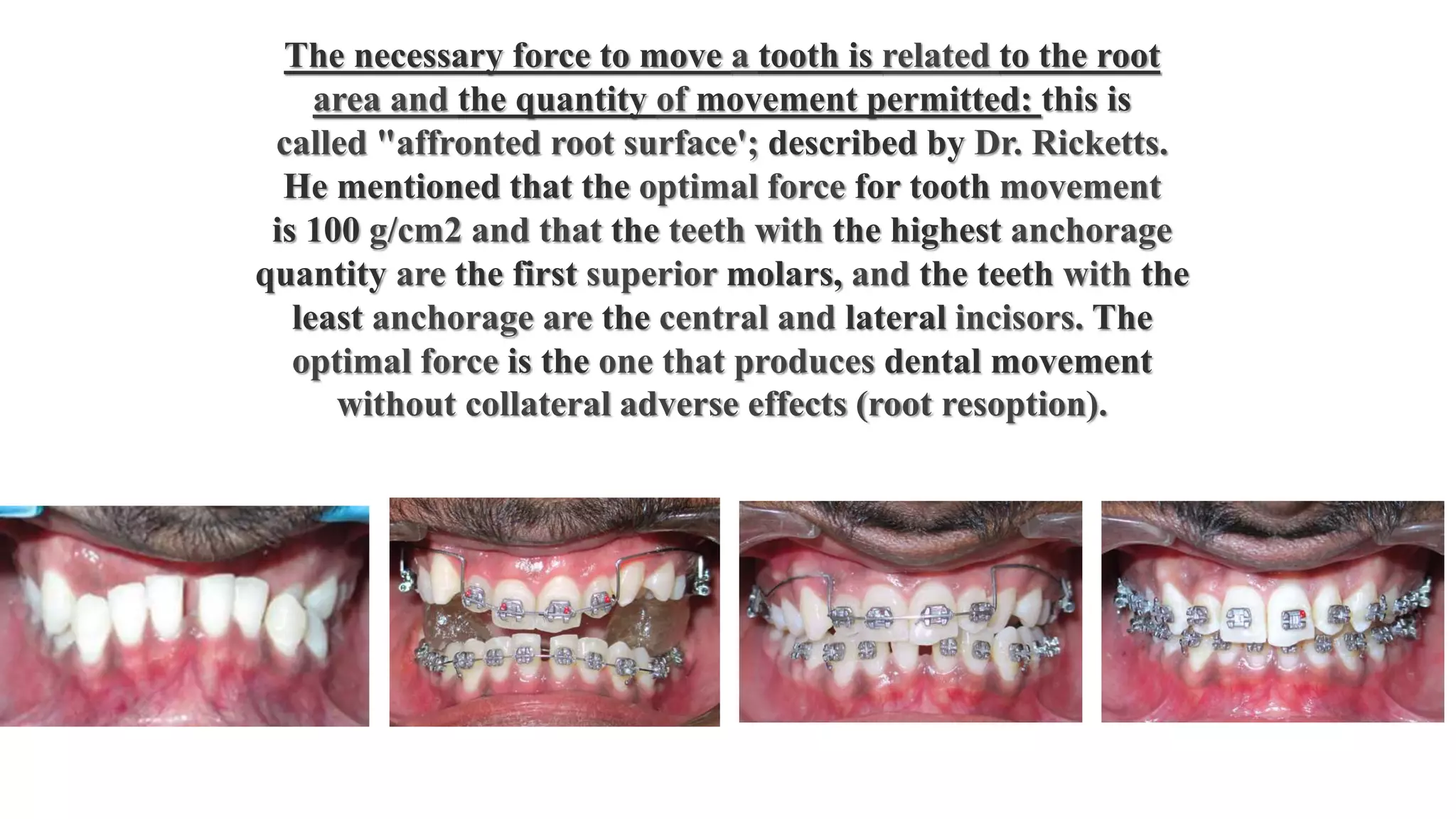 Anchorage in orthodontics | PPTX | Dental Health | Diseases and Conditions