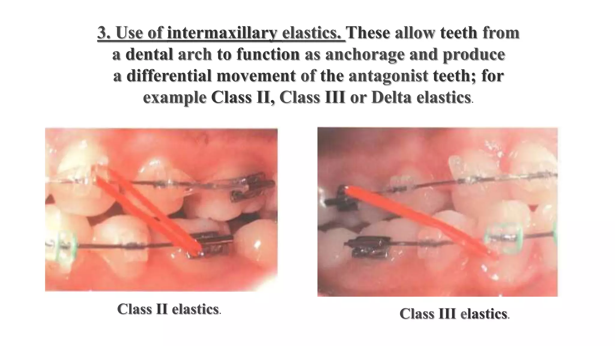 Anchorage in orthodontics | PPTX