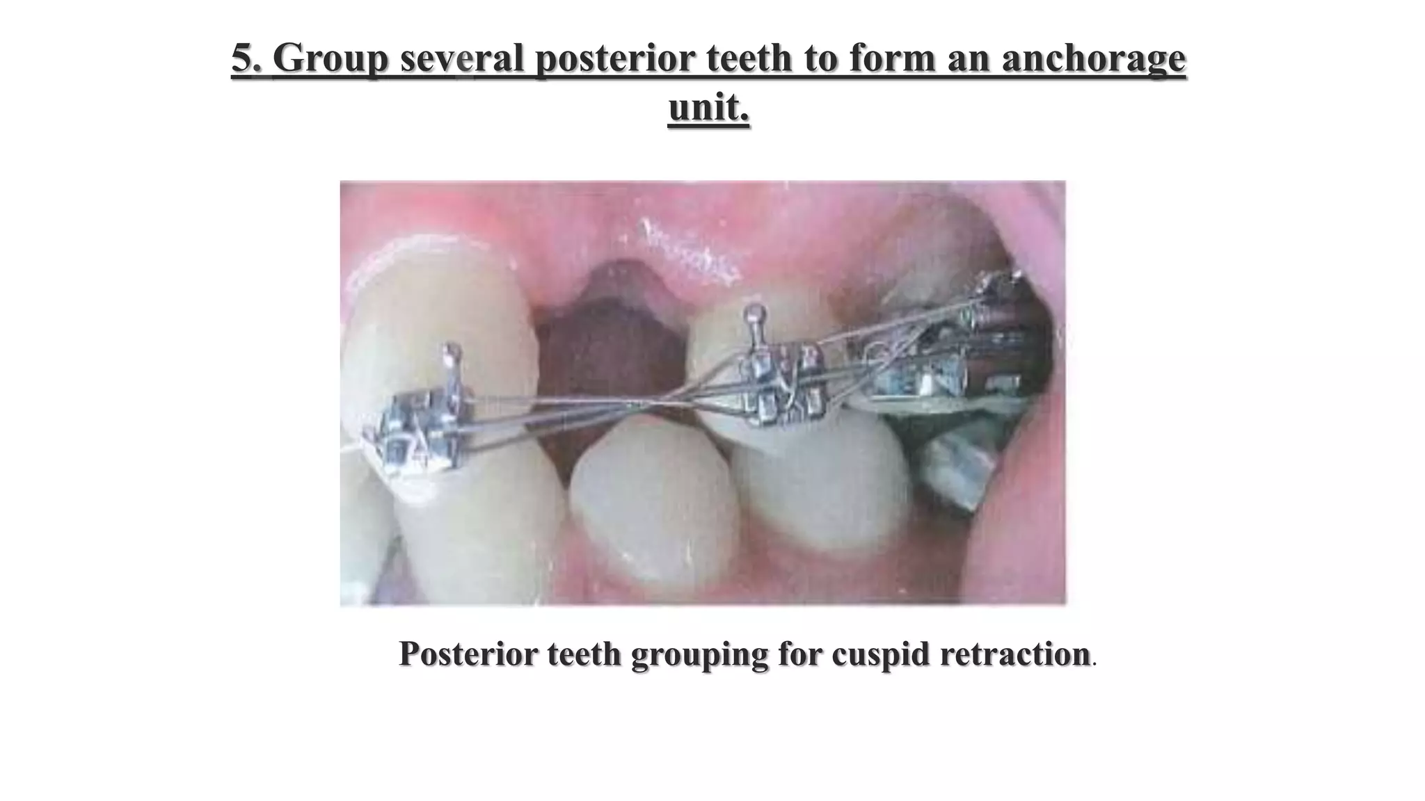 Anchorage in orthodontics | PPTX