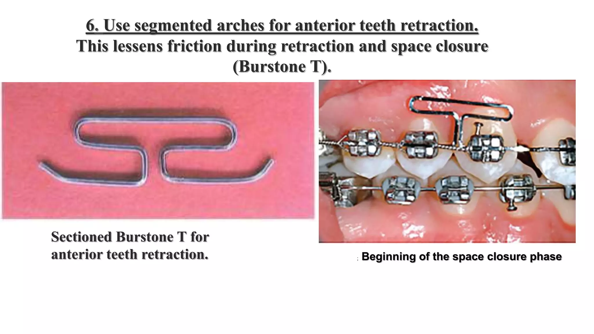 Anchorage in orthodontics | PPTX