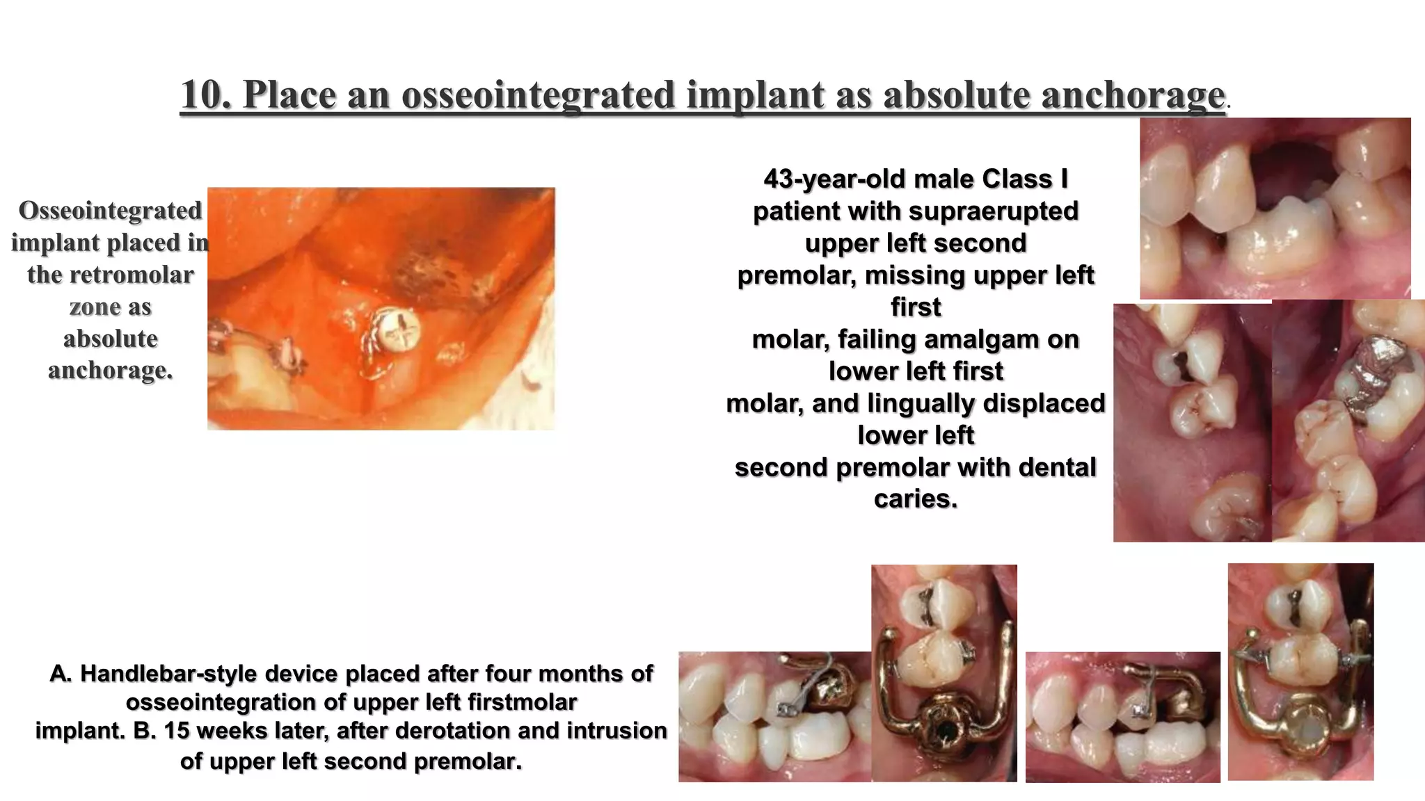 Anchorage in orthodontics | PPTX