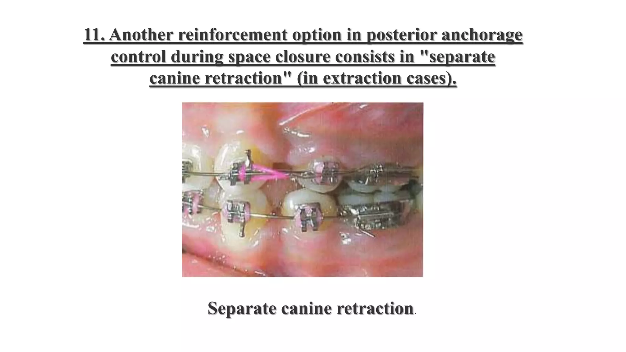 Anchorage in orthodontics | PPTX | Dental Health | Diseases and Conditions