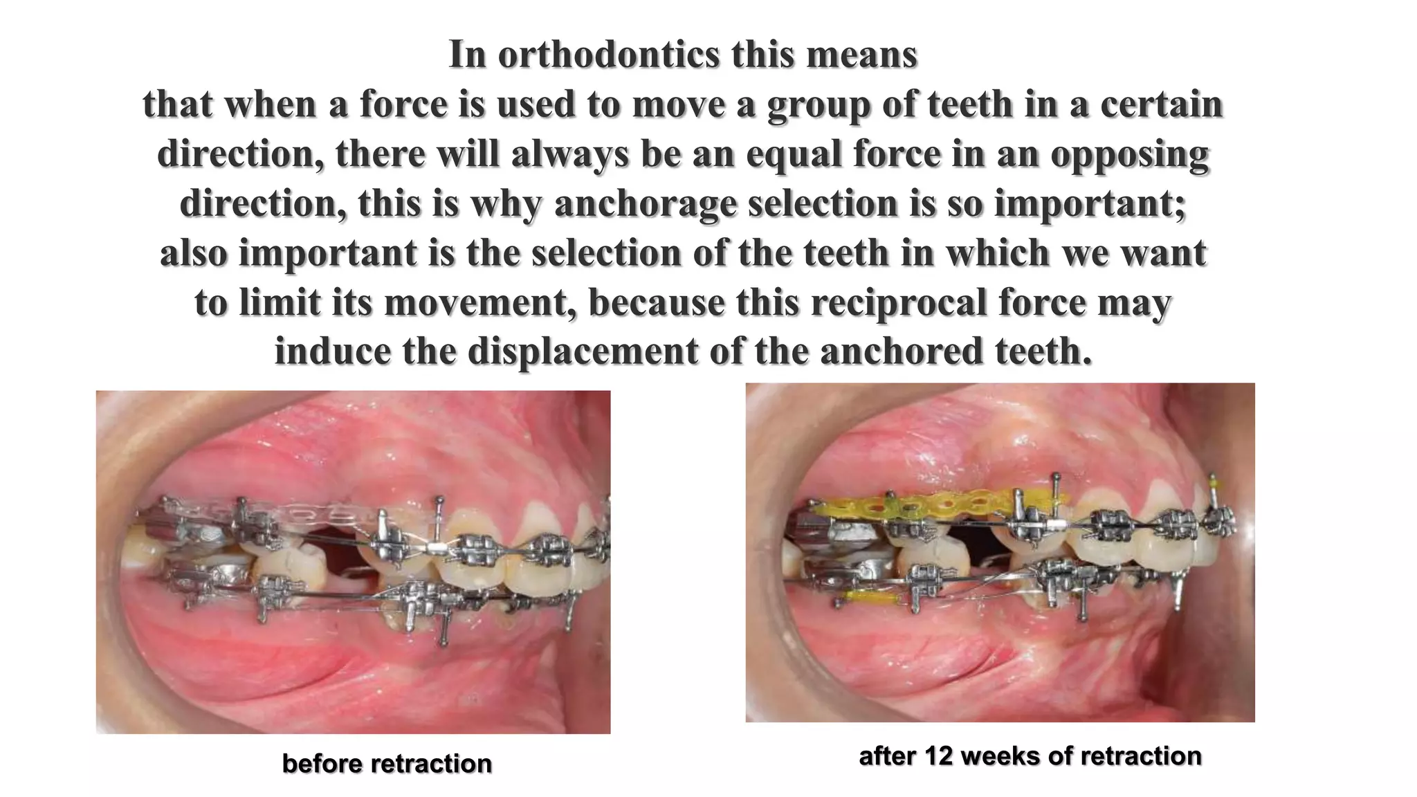Anchorage in orthodontics | PPTX