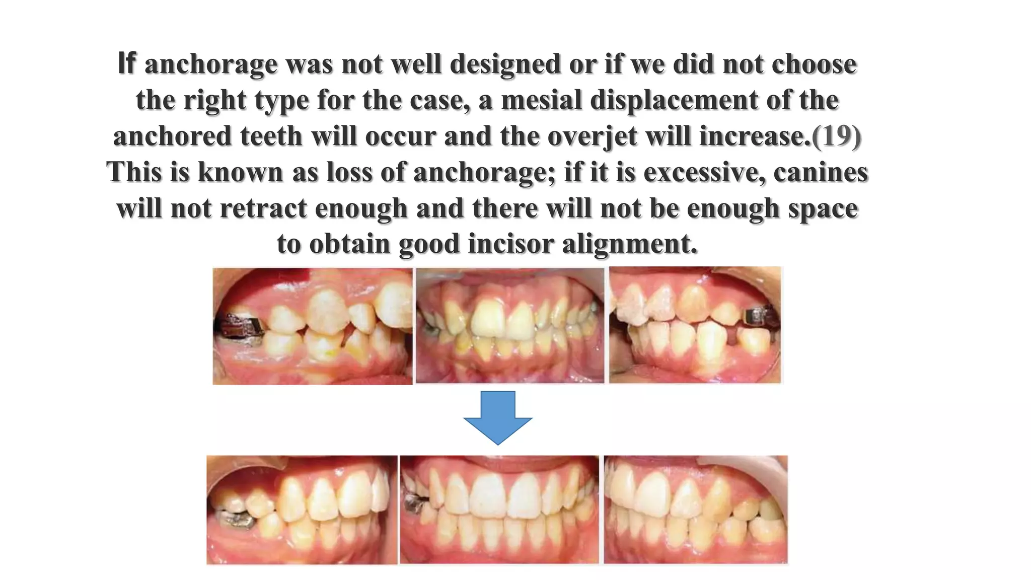 Anchorage in orthodontics | PPTX