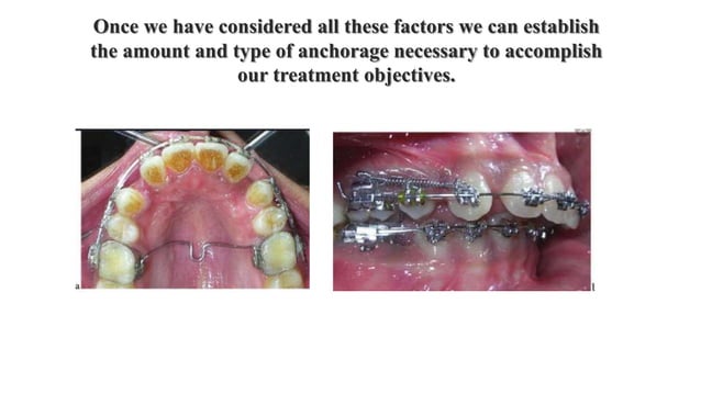 Anchorage in orthodontics | PPTX | Dental Health | Diseases and Conditions