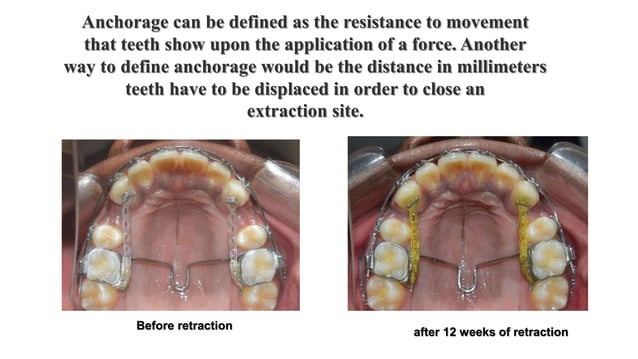Anchorage in orthodontics | PPTX | Dental Health | Diseases and Conditions