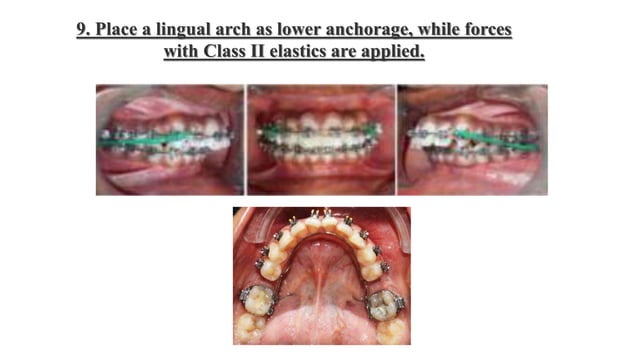 Anchorage in orthodontics | PPTX | Dental Health | Diseases and Conditions