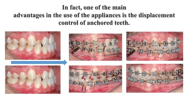 Anchorage in orthodontics | PPTX | Dental Health | Diseases and Conditions