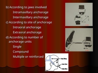 Comprehensive Overview of Anchorage in Orthodontics: Principles ...