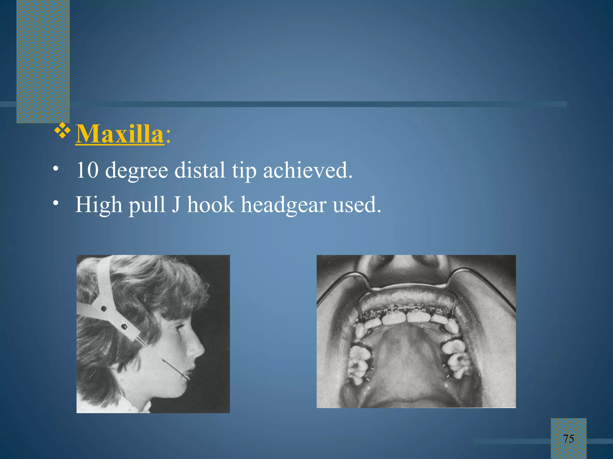 Anchorage in orthodontics ppt | PPT