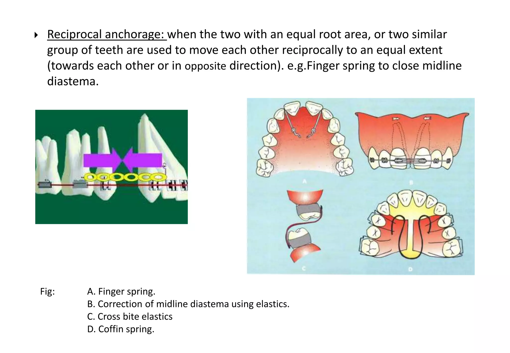 Anchorage & it’s variants | PPTX