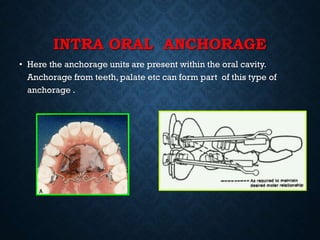 Anchorage( orthodontics) | PPTX