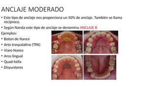ANCLAJE,CONCEPTO,TIPOS Y MANEJO CLINICO.pptx